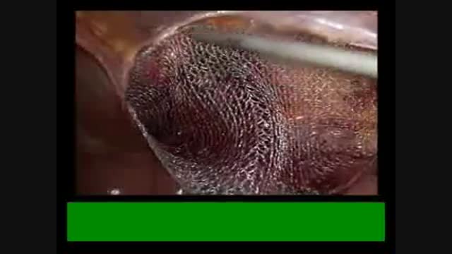 جراحی لاپاروسکوپیک هرنی کشاله ران سمت راست با دوختن حلقه فتق نماشا